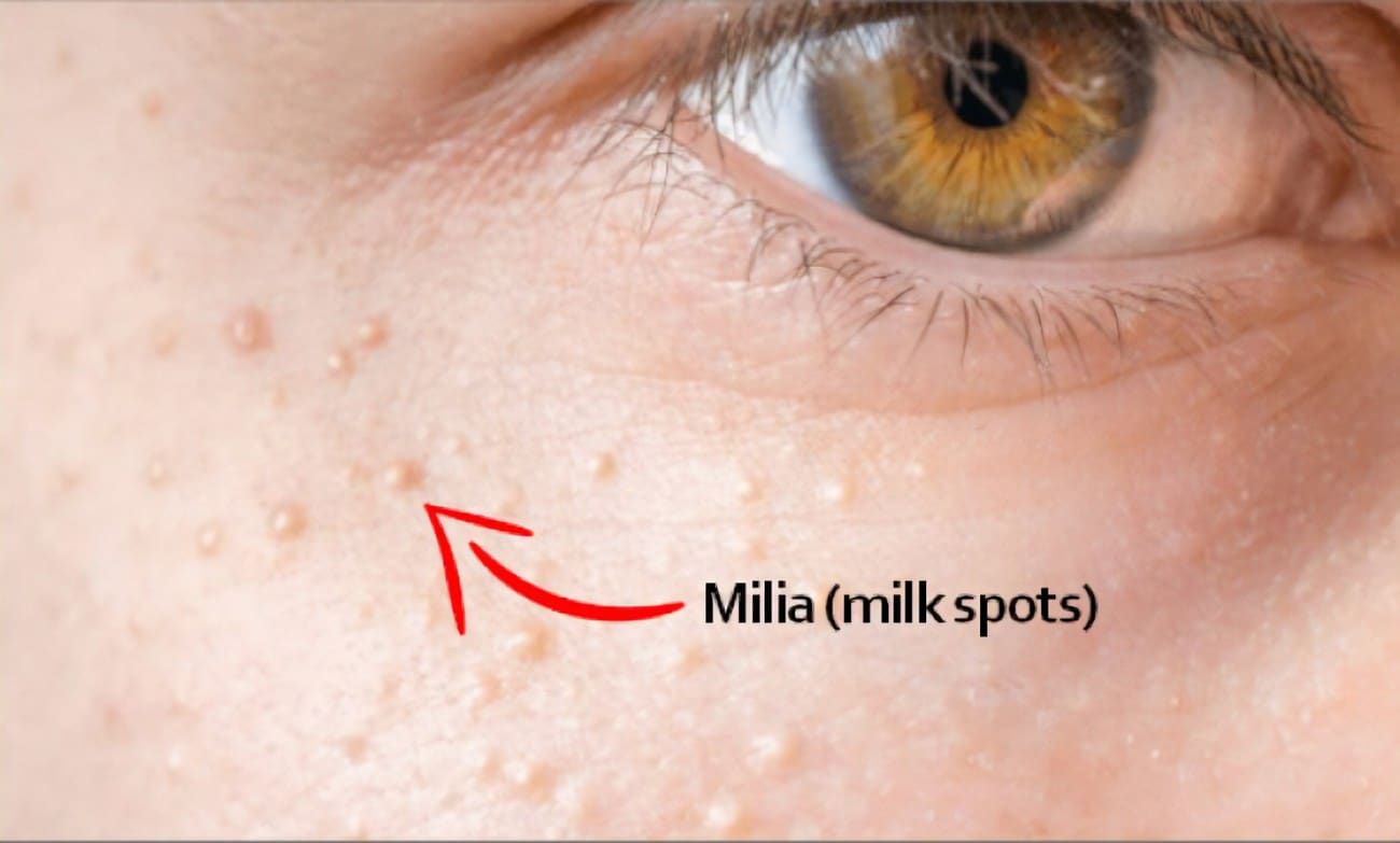 Milia or Milk Spot- symptoms and treatment - Irsa clinic