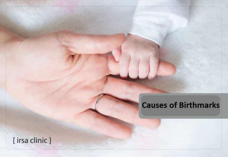 What is a Birthmark? - Irsa dermatology clinic